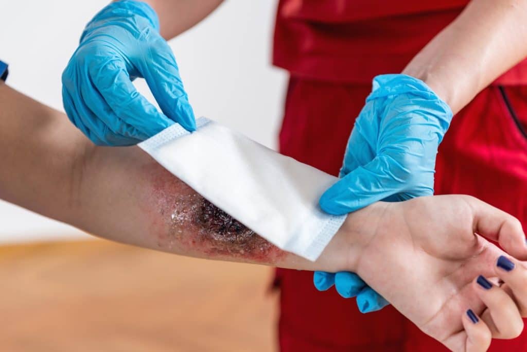 Burn Injury Complications, Explained - Biby Law Firm